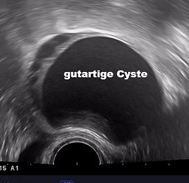 FAQ Myome Cysten | drbartosch