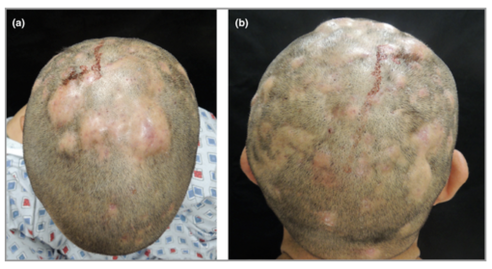 Foliculite Dissecante do couro cabeludo