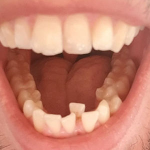 Can Invisalign or some other method fix my severely crowded teeth ...