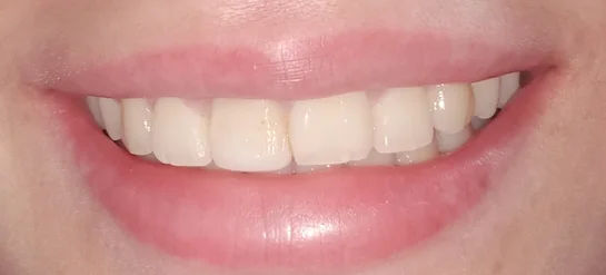 My lateral incisors are too big. What can be done to fix this? (Photo ...