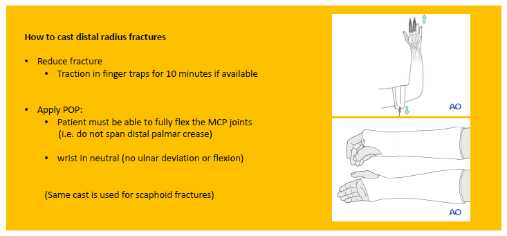 Scaphoid fractures | Mtwortho