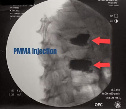 Kyphoplasty | Pain Management | Murrieta CA | Temecula CA