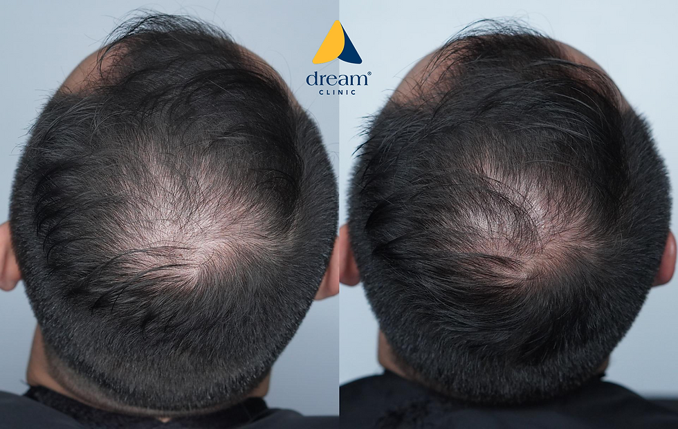 The Ultimate Hair Revival : Why PRF Therapy is a Game Changer