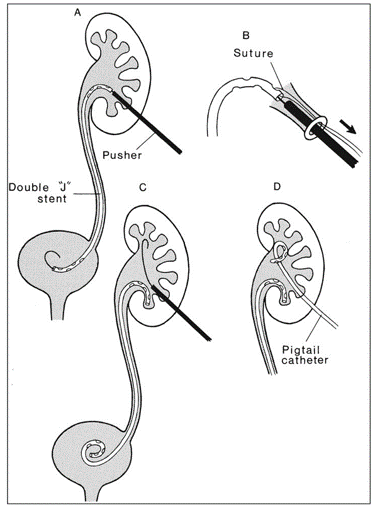 Urinary drainage catheters: nephrostomies and ureteral stents