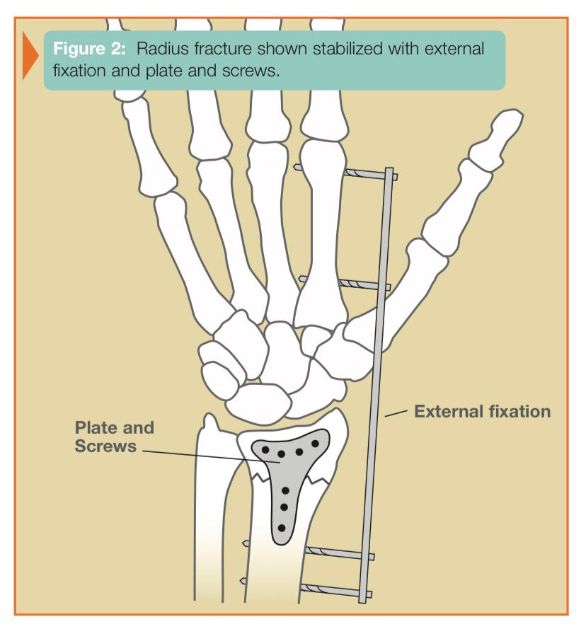 Distal Radius Fractures | Jonathan Twu MD