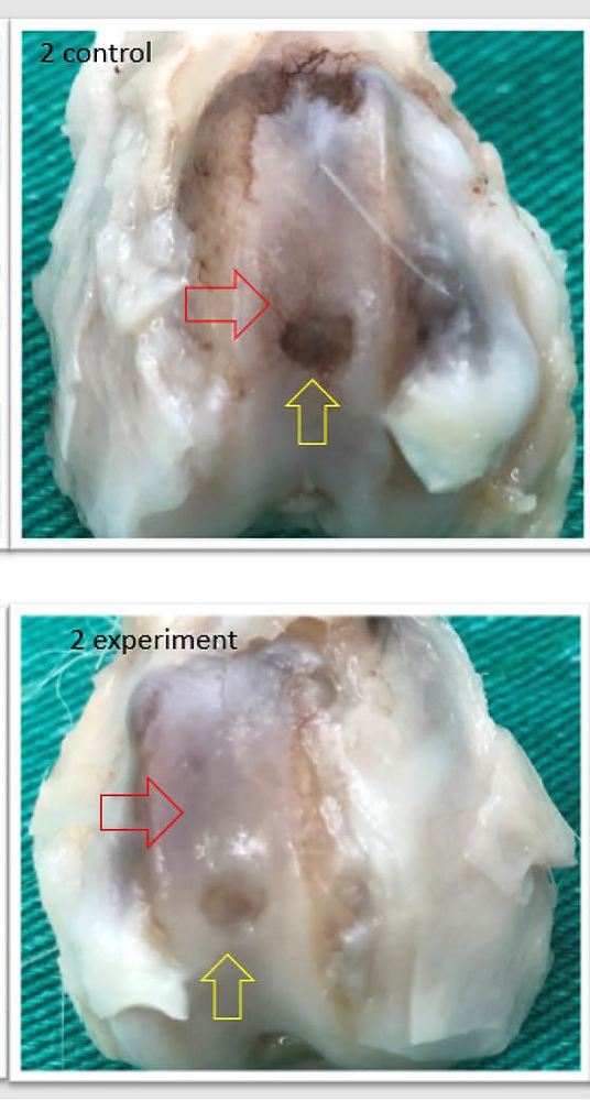 Porcine Platelet Lysate Intra articular Knee Joint Injections for the ...