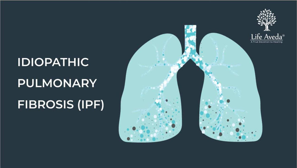Idiopathic Pulmonary Fibrosis