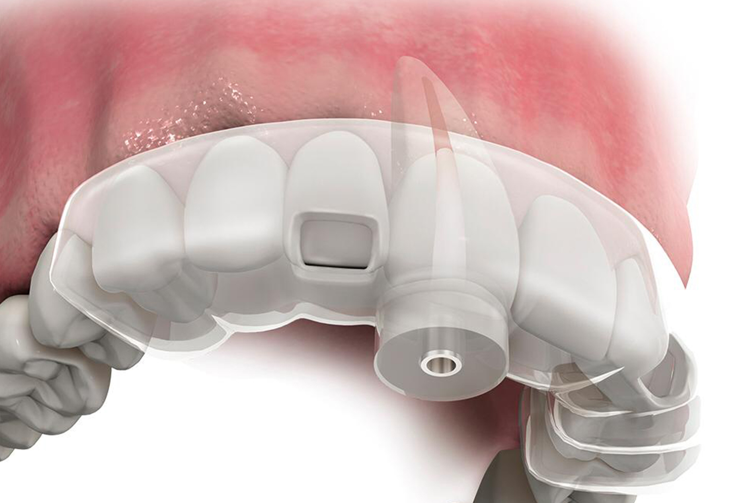 SliceLAB | Endoguide 3D - Tratamento de Canal Guiado