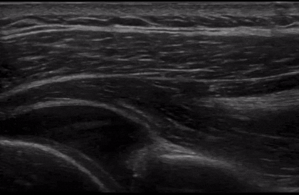 How is Shoulder Hydrodilatation or Hydrodistension Done?