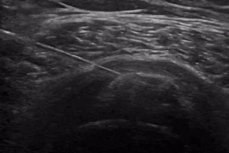 How is shoulder barbotage/lavage "treating calcific tendonitis" done?