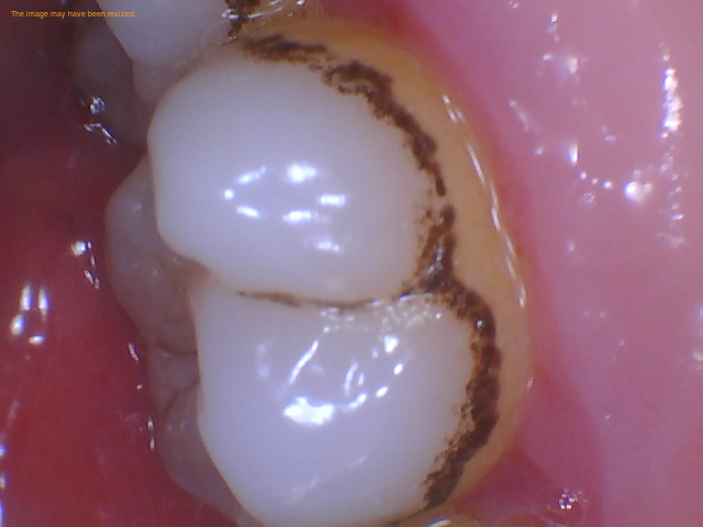 Black Tartar On Teeth - What On Earth Is This?