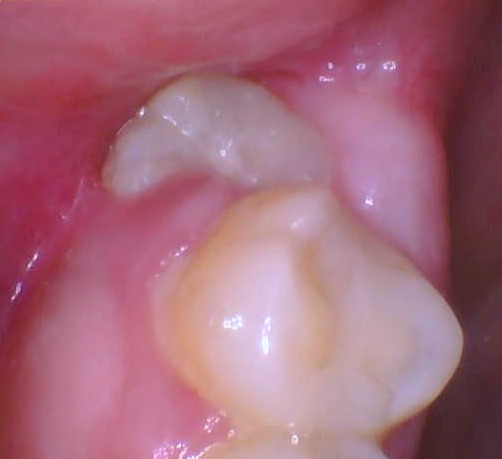 Pictures of Real Wisdom Teeth - 1311 Jackson Ave Dental | Dentist in ...