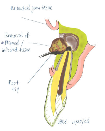 Apicoectomy Dental Procedure: Things To Know - 1311 Jackson Ave Dental ...