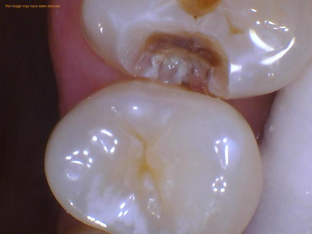 1 surface filling vs 2 surface filling: Differences - 1311 Jackson Ave ...