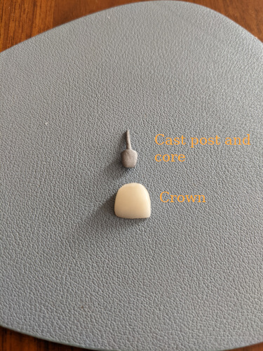 Crown With Post: Things To Know - 1311 Jackson Ave Dental | Dentist in ...