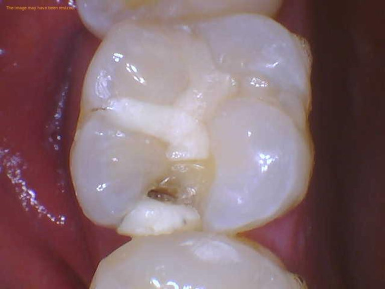 Dental Fillings (Cavity Filling): Things To Know - 1311 Jackson Ave ...