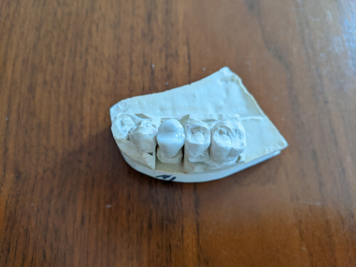 Porcelain Fused To Metal Crowns (PFM): Things To Know - 1311 Jackson ...