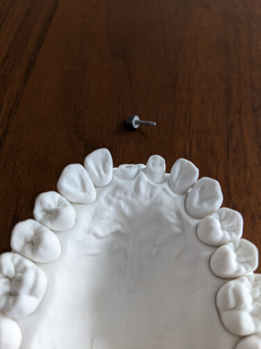 Cast Post And Core Dental Procedure: Things To Know - 1311 Jackson Ave ...