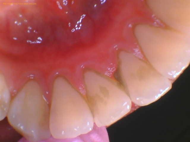 All The Different Types Of Teeth Stains - 1311 Jackson Ave Dental ...