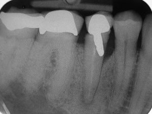 Cast Post And Core Dental Procedure: Things To Know - 1311 Jackson Ave ...