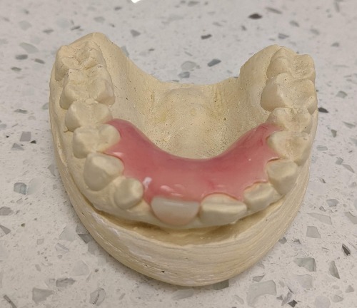 What a Flipper Tooth Looks Like - 1311 Jackson Ave Dental | Dentist in ...