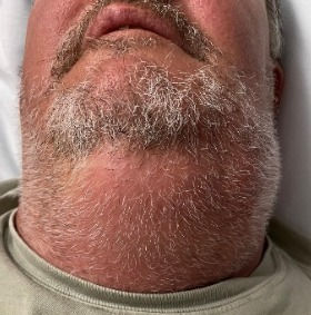 What Does An Abscess Tooth Look Like?