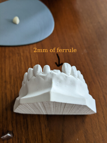 Crown With Post: Things To Know - 1311 Jackson Ave Dental | Dentist in ...