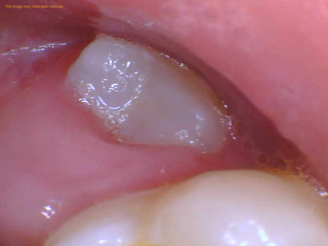 Can I Pull My Own Wisdom Tooth? - 1311 Jackson Ave Dental | Dentist in ...