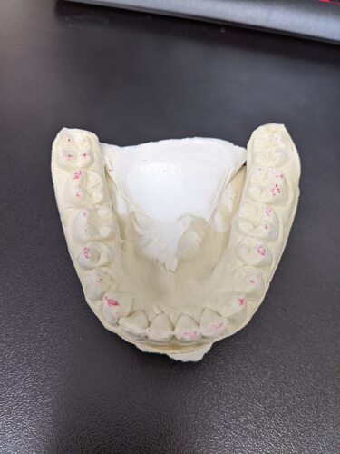 Signs & Symptoms of a Bad Fitting Crown - 1311 Jackson Ave Dental ...