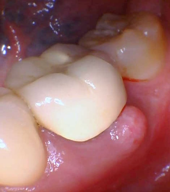 abscess between front teeth