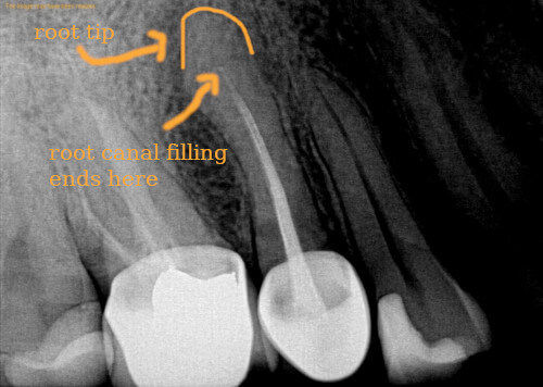 Failed Root Canals On X Rays What To Do 1311 Jackson Ave Dental Dentist In Long Island