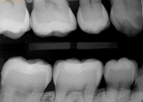 What Does A Cavity Look Like On An X-Ray?