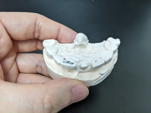 Porcelain Fused To Metal Crowns (PFM): Things To Know - 1311 Jackson ...