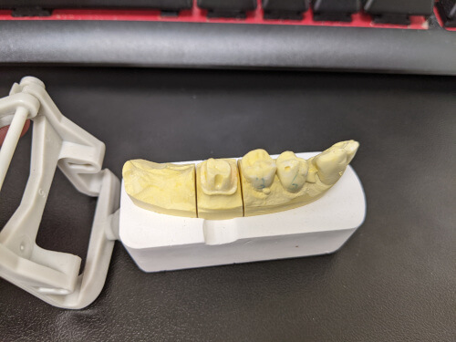 My Zirconia Crown Keeps Coming Off - 1311 Jackson Ave Dental | Dentist ...