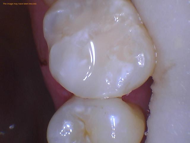 1 surface filling vs 2 surface filling: Differences - 1311 Jackson Ave ...