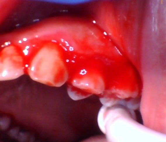 severe bleeding gums