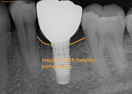 Dental Implant Screw Showing: Causes & Treatment - 1311 Jackson Ave ...