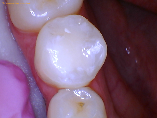 9 reasons you have tooth sensitivity after filling