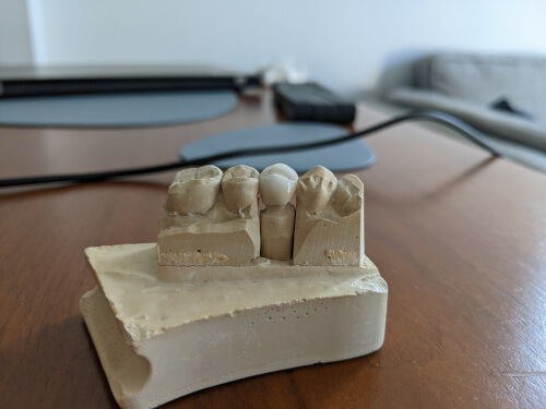 Porcelain Fused To Metal Crowns (PFM): Things To Know - 1311 Jackson ...