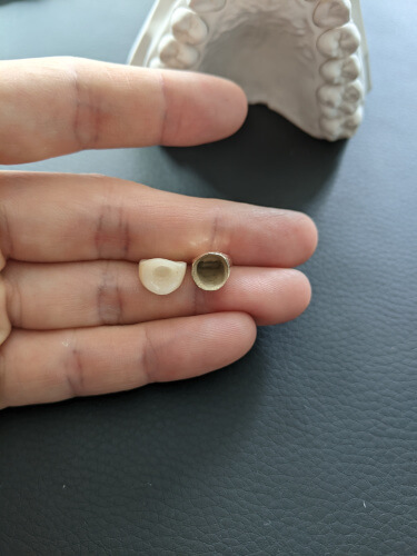 Gold Tooth Crown: Things To Know - 1311 Jackson Ave Dental | Dentist in ...