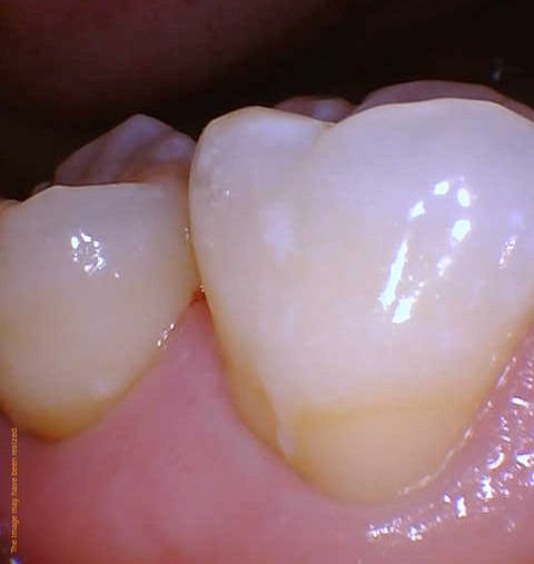 Why Do My Teeth Hurt Drinking Cold Beverages