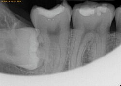 Options For a Broken Wisdom Tooth