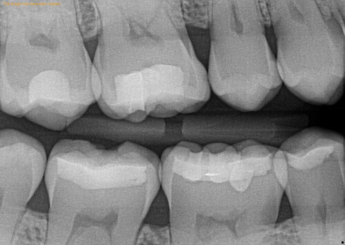Dental X-rays: Things To Know - 1311 Jackson Ave Dental | Dentist in ...