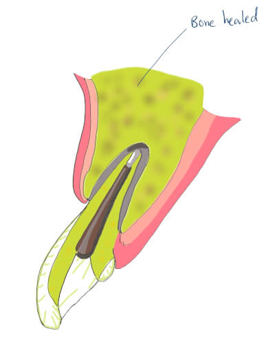 Apicoectomy Dental Procedure: Things To Know - 1311 Jackson Ave Dental ...