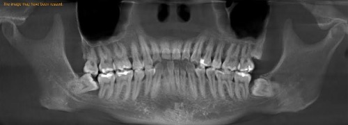 Pictures of Real Wisdom Teeth - 1311 Jackson Ave Dental | Dentist in ...