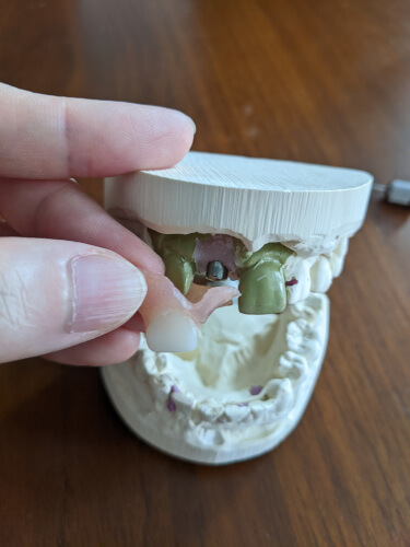 Wearing a Flipper Tooth With a Healing Abutment - 1311 Jackson Ave ...