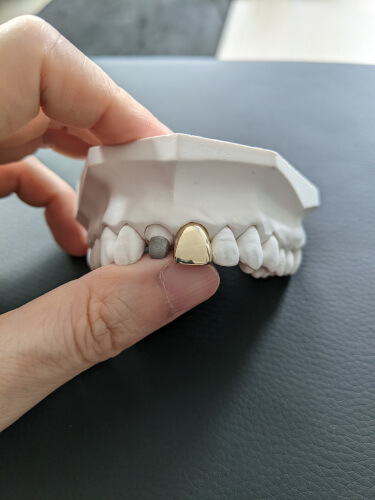 Gold Tooth Crown: Things To Know - 1311 Jackson Ave Dental | Dentist in ...