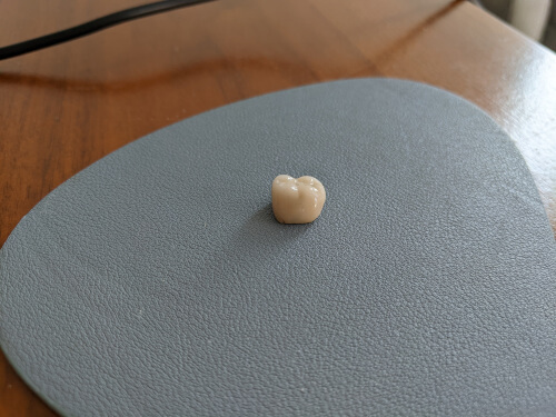 Porcelain Fused To Metal Crowns (PFM): Things To Know - 1311 Jackson ...