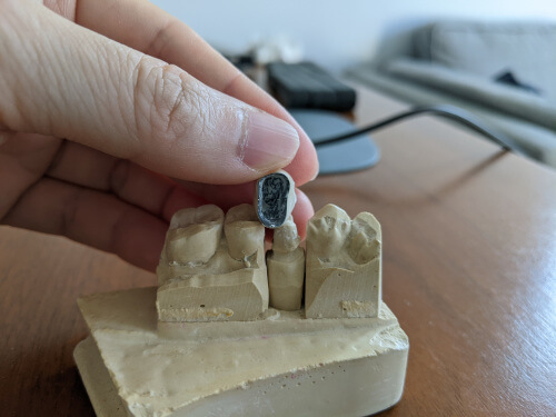 Porcelain Fused To Metal Crowns (PFM): Things To Know - 1311 Jackson ...