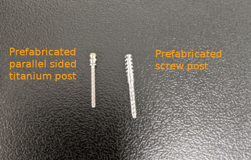 Prefabricated Post And Core: Things To Know - 1311 Jackson Ave Dental ...